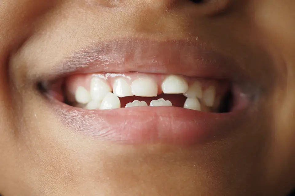 Cracked Teeth Repair - North Hill Dental - Richmond Hill, ON
